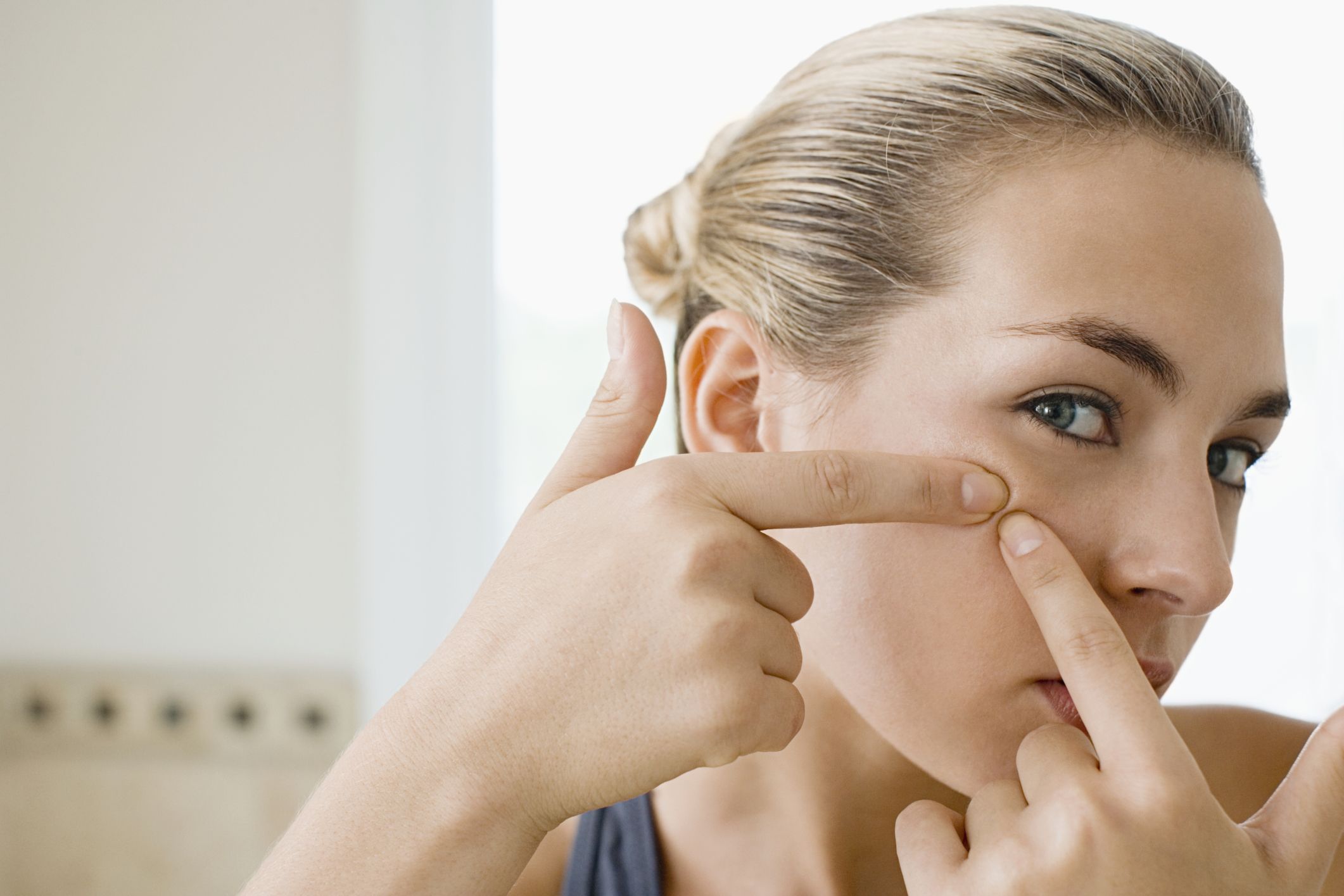 10 Effective Home Remedies For Pimples On Chin SmuGG BuGG 10 Effective Home Remedies For Pimples On Chin SmuGG BuGG